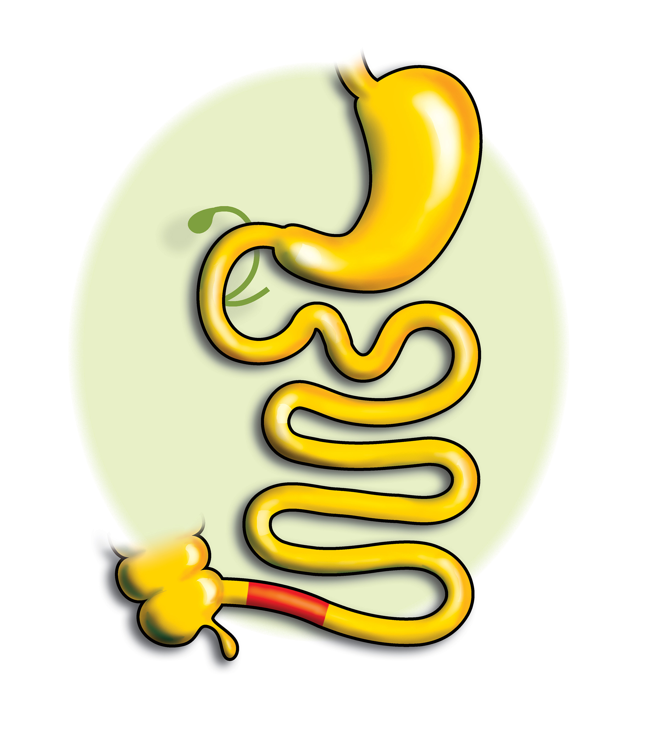 Obesitaskirurgi - Illustratörcentrum