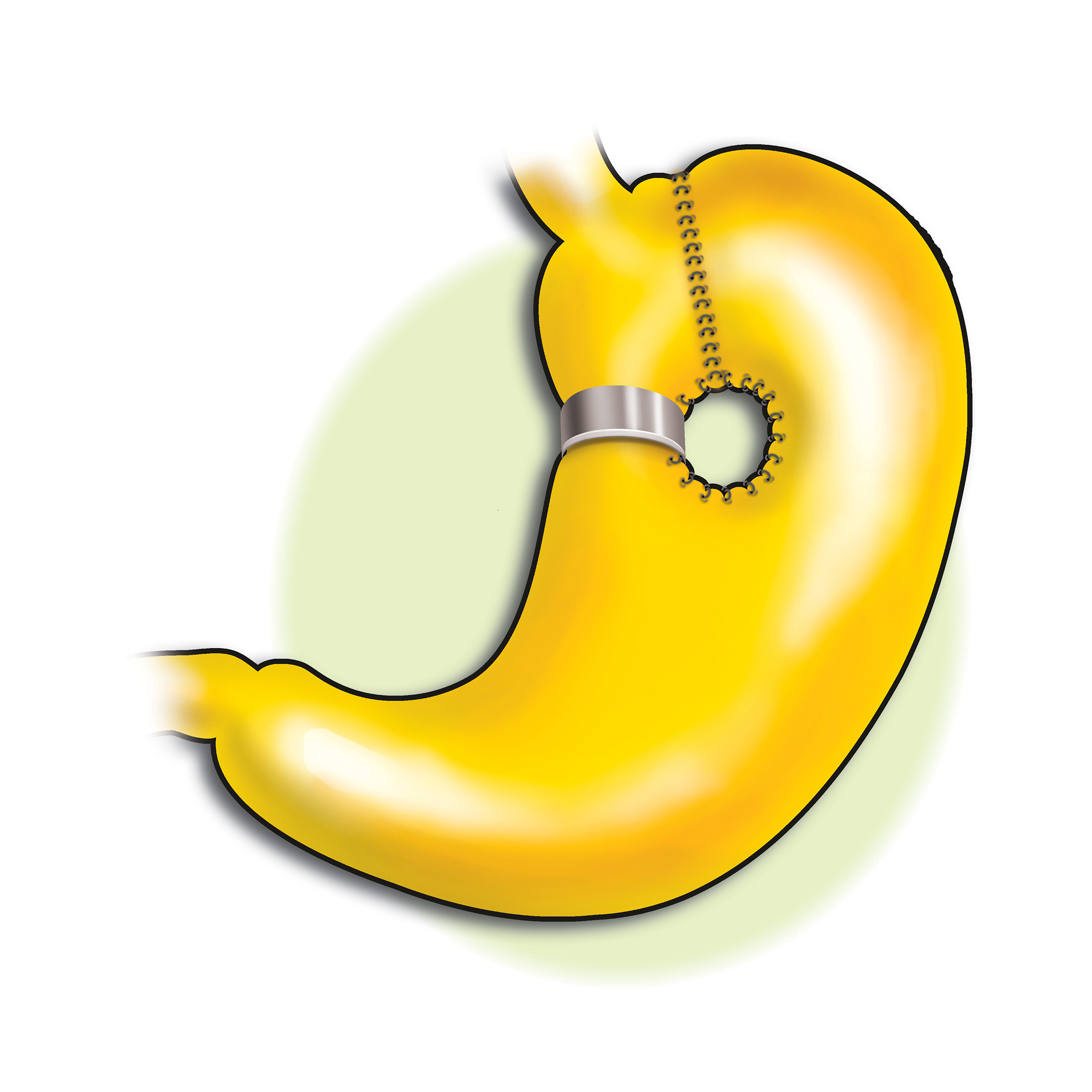 Obesitaskirurgi - Illustratörcentrum