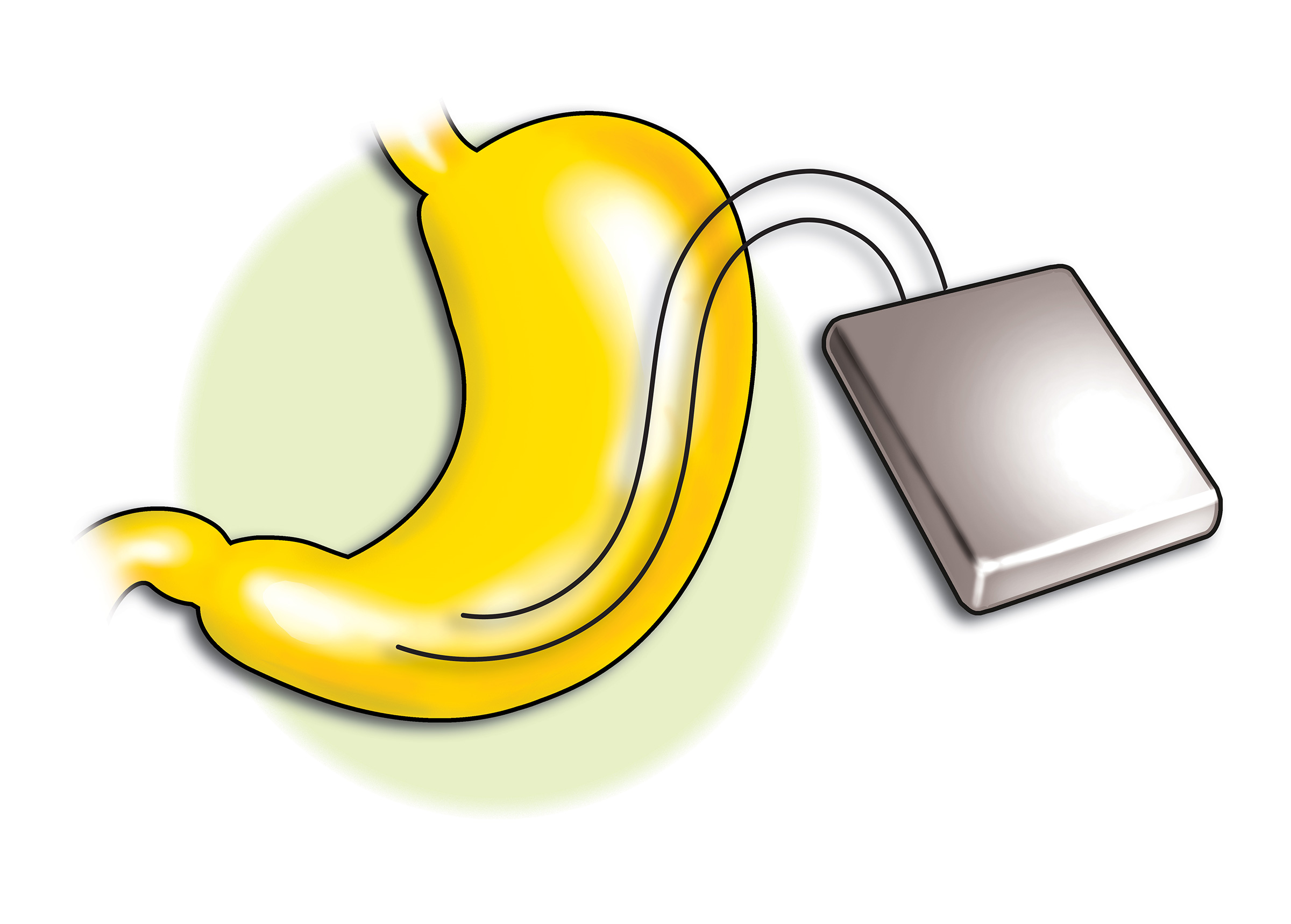 Obesitaskirurgi - Illustratörcentrum